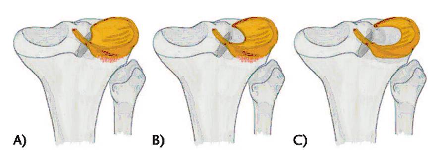 MENISCO DISCOIDE. COS'E', DIAGNOSI, TRATTAMENTO