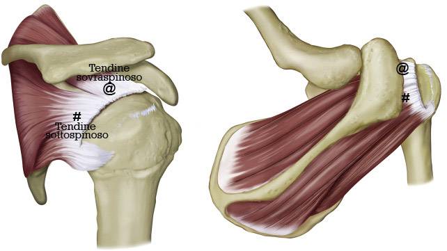 NUOVA TECNICA CHIRURGICA PER LESIONE GRAVE DEI TENDINI ALLA SPALLA