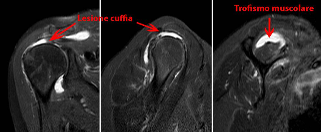Croce. Riparazione in artroscopia di lesione ampia cuffia dei rotatori ...