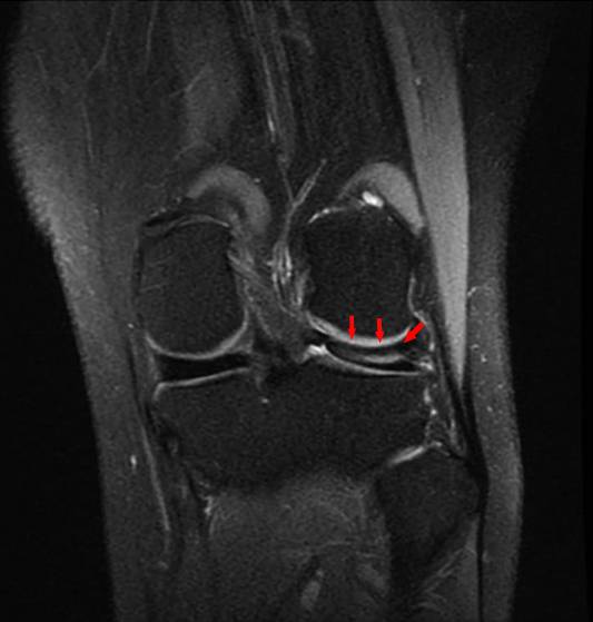 MENISCO DISCOIDE. COS'E', DIAGNOSI, TRATTAMENTO
