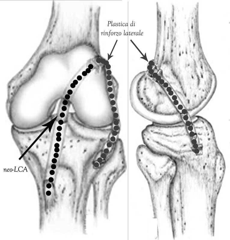 Operazione crociato anteriore: ricostruzione del legamento